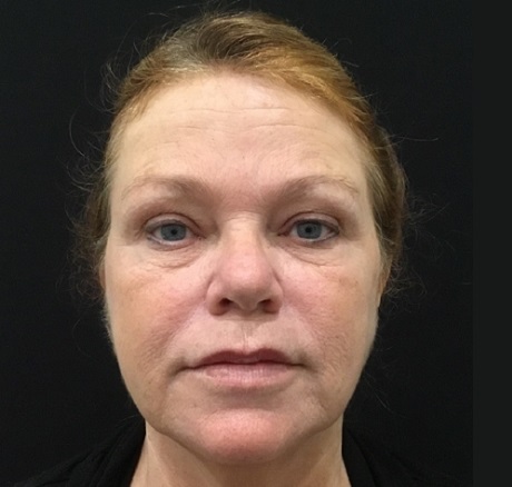 6886 Before and After Photos Melbourne, FL