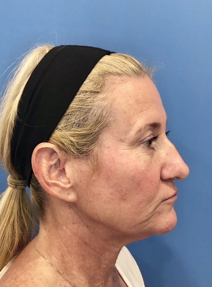 6882 Before and After Photos Melbourne, FL