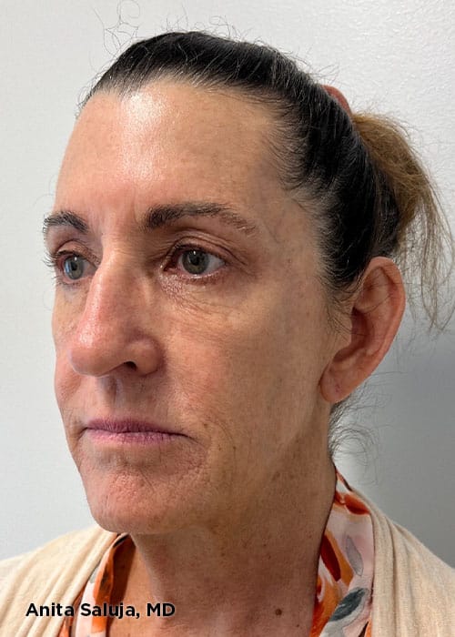 67574 Before and After Photos Melbourne, FL